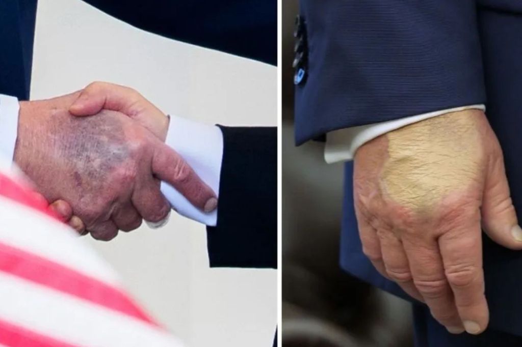 ‘Right to know’: Trump’s mystery bruises spark wild speculation - News ...